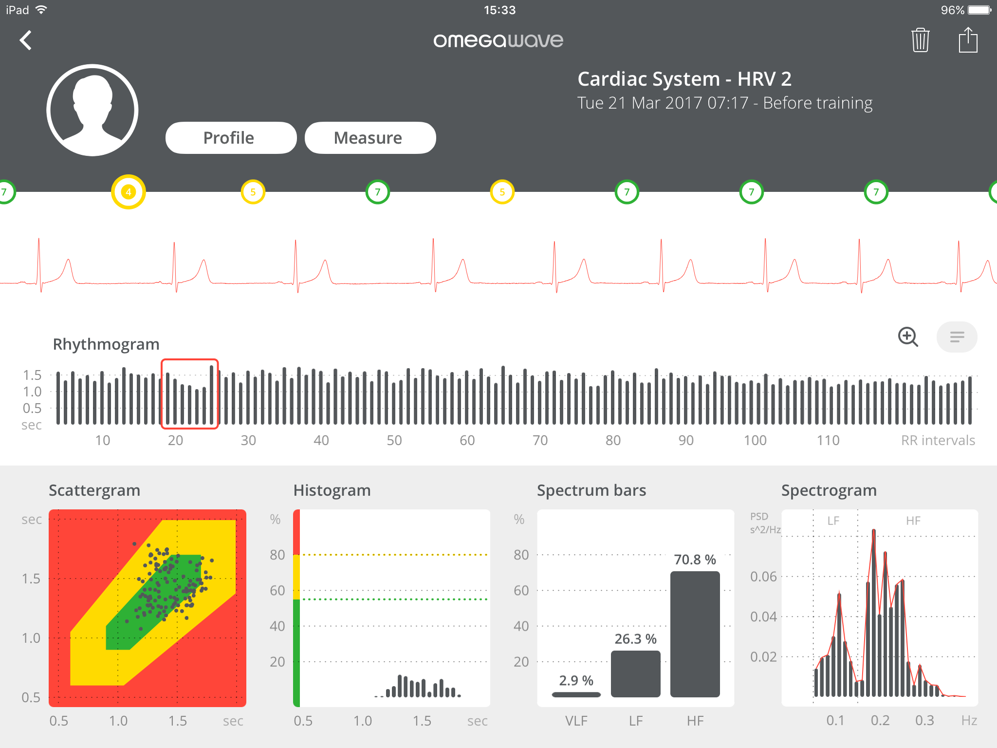 Pre-empting severe cardiac issues with Omegawave - A case study – Omegawave